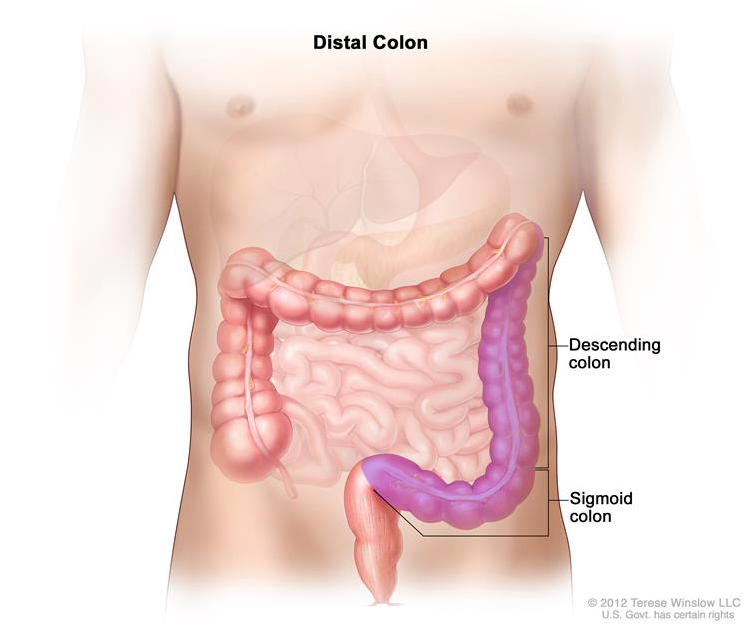Diagram Of Distal Colon Holistic Hernia Remediation