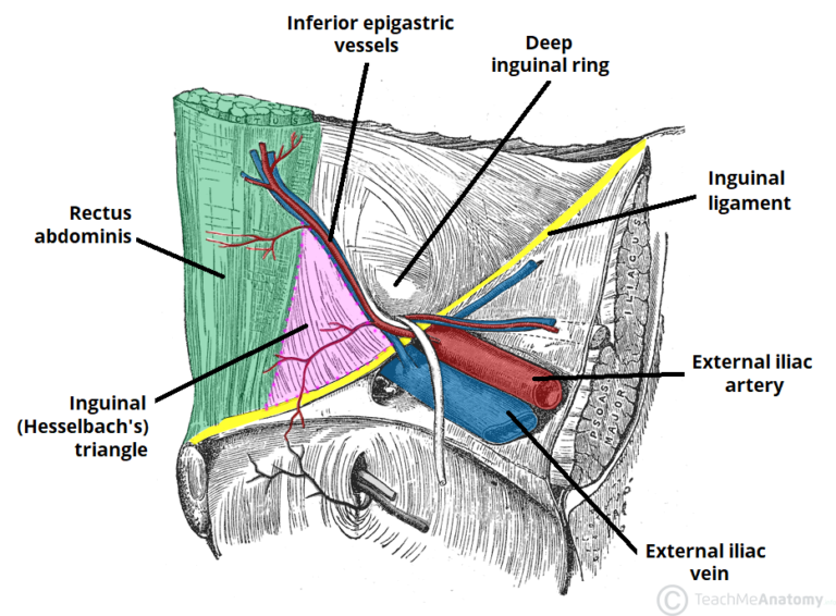 Hesselbach’s Triangle (Diagram) – Holistic Hernia Remediation